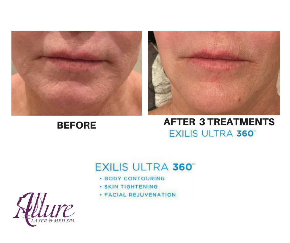 BTL and Exilis 360 (Skin Tightening) Tinley Park IL - Allure Laser and ...